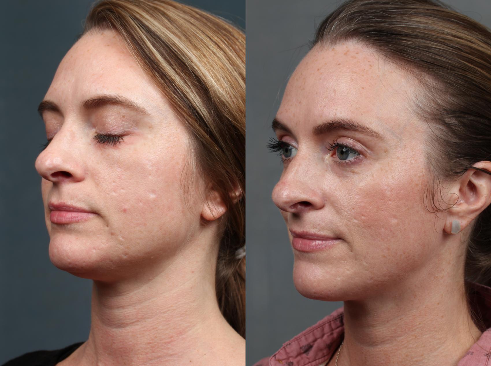 INFINI Before & After Photos Patient 696 | Louisville, KY | CaloSpa ...