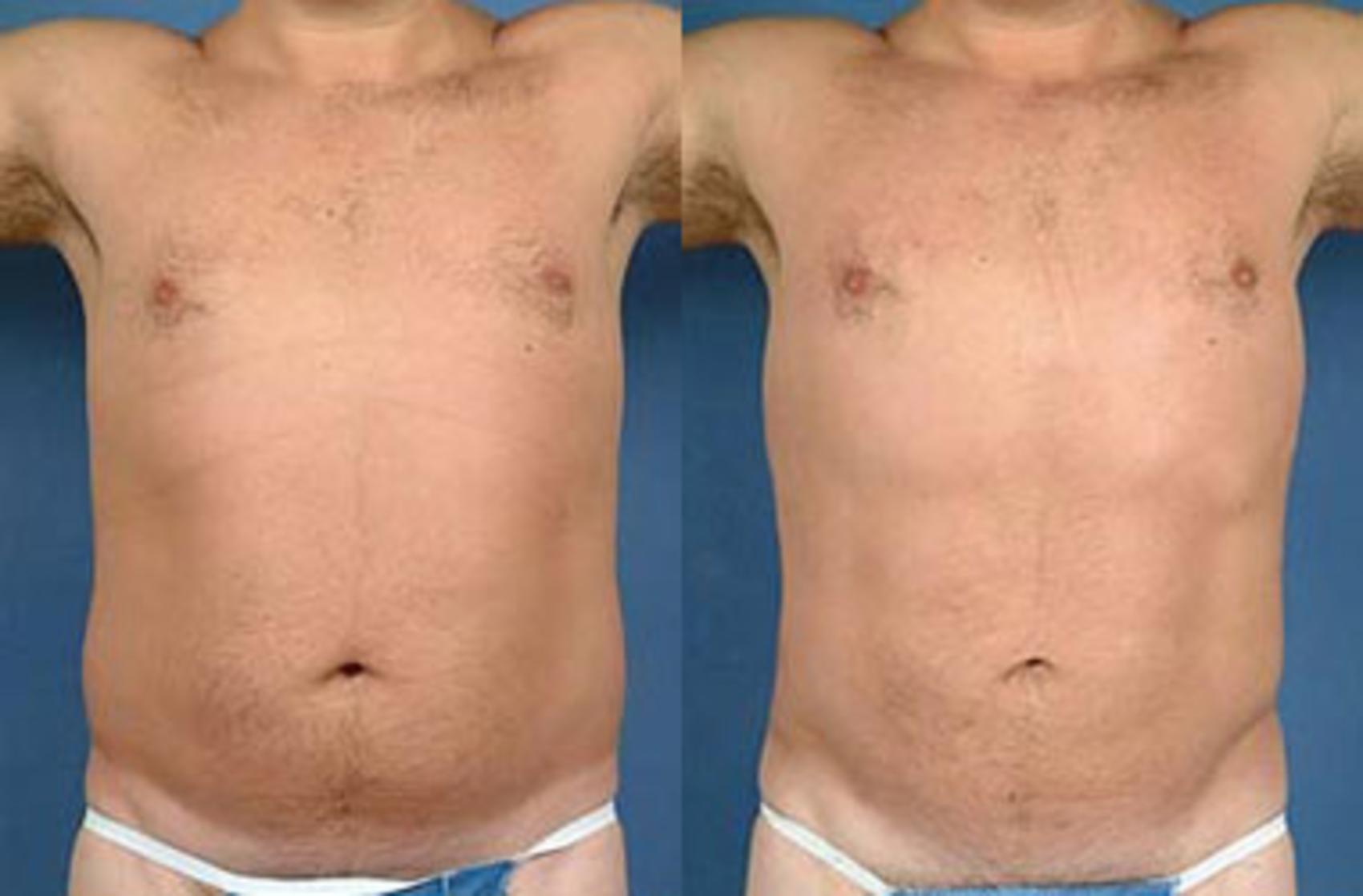 Liposuction for Men Before & After Photos Patient 129 | Louisville, KY ...